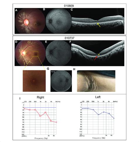 Atypical Retinal Features Of Patients 010809 And 010737 And Systemic Download Scientific
