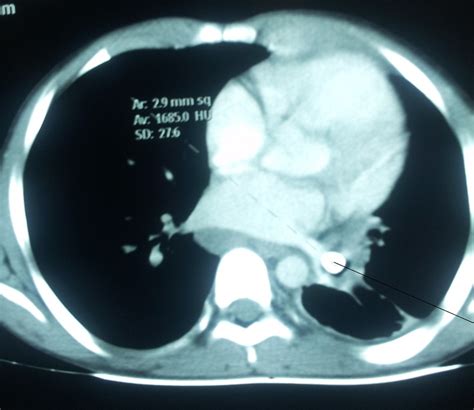 Inhaled Foreign Body Mismanaged As Tb Finally Removed Using A Rigid