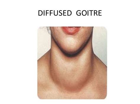 Diffused Goitre Diffused Goitre