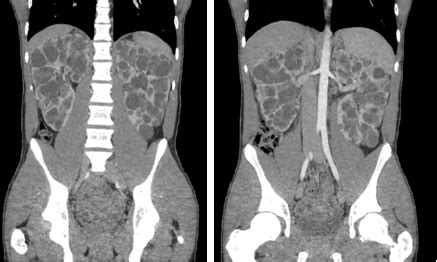 Poliquistosis Renal Autosómico Dominante