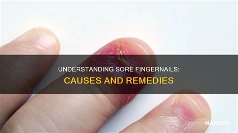 Understanding Sore Fingernails Causes And Remedies Nailicy