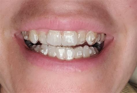 Tray 18 33 R Invisalign