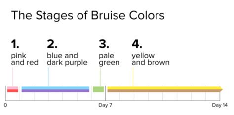 Cara Mengobati Luka Memar Akibat Terbentur Atau Jatuh