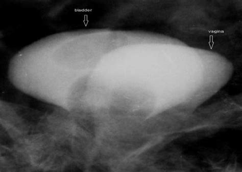 Cystogram Demonstrating A Vvfa Anteroposterior View The Contrast