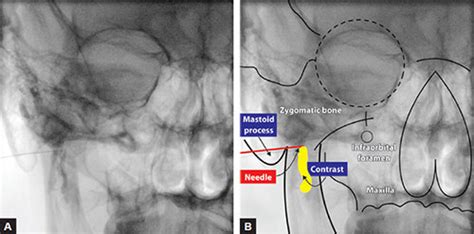 Glossopharyngeal Nerve Block Fluoroscopy