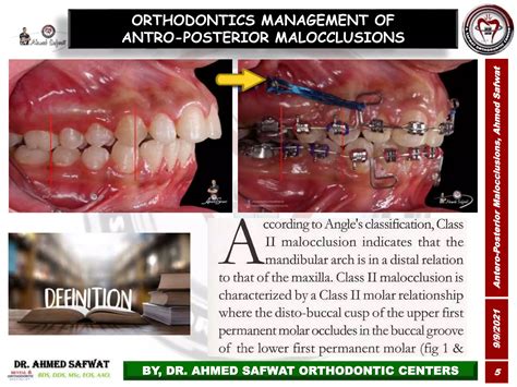 Orthodontic Management Of Class Ll Malocclusion By Ahmed Safwat Pptx