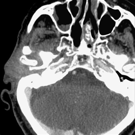 Squamous Cell Cancer Of Eac Axial Contrast Enhanced Ct Demonstrates