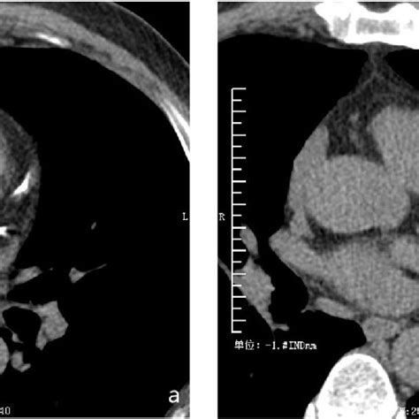 A B The Cacs Agatston Score Measured By Ecg Gating Method Is 1986 Download Scientific Diagram