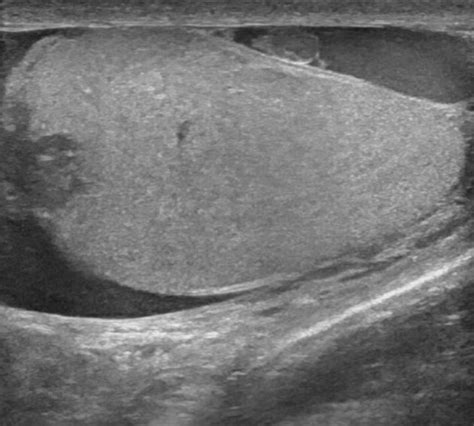 Testicular Rupture Ultrasound Testicular Rupture A Sagittal
