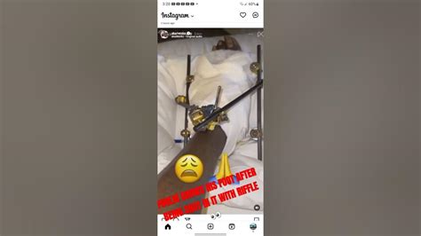 Foolio Shows His Foot After Being Shot In It With Riffle 👀 Juliofoolio