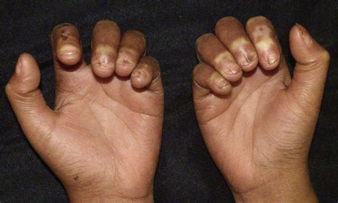 Contractures Limiting Flexion Of Second Through Fifth Distal