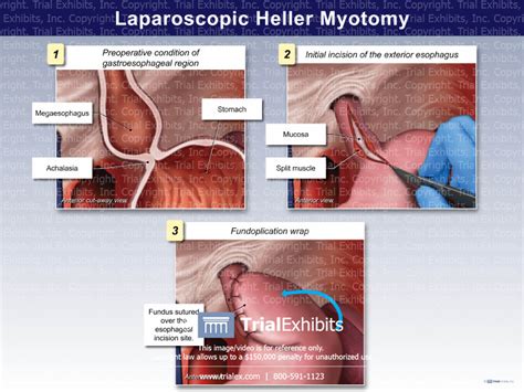 Laparoscopic Heller Myotomy Trialquest Inc
