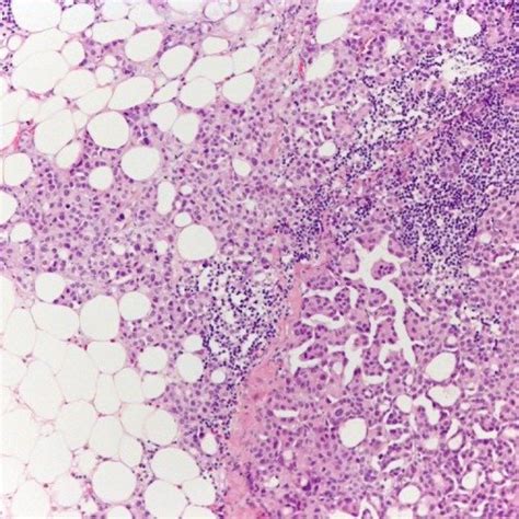 Pdf Pelvic Lymph Node Dissection In The Context Of Radical Cystectomy