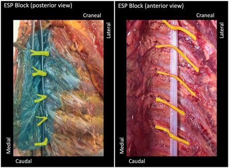 Understanding The Local Anesthetic Spread In Paraspinal Blocks A