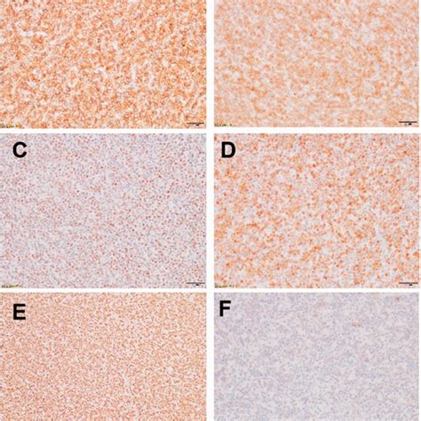 Excisional Lymph Node Biopsy With Immunohistochemistry In A Patient