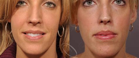 Do Cheek Implants Make A Difference