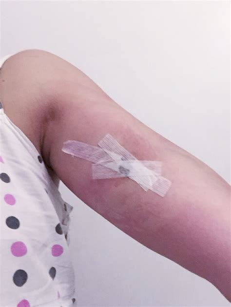 Nexplanon Bandage Removal At Gary Delong Blog