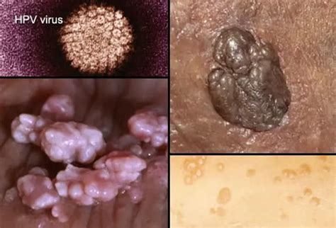 Std Pictures Herpes Genital Warts Gonorrhea Std Symptoms And Testing