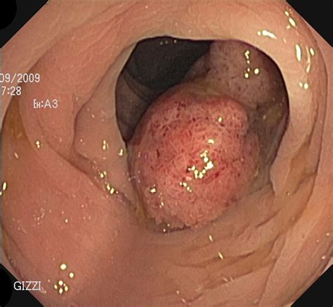 2a Large Polyp Of Transverse Colon Colon Explorer