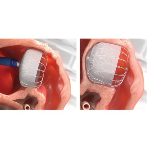 Left Atrial Appendage Occlusion Healthcare And Medical News For