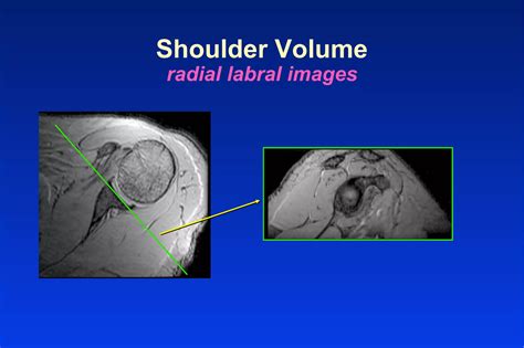 Pulse Sequences Gradient Echo Ppt