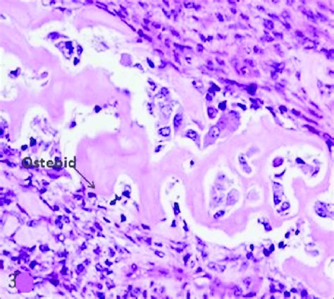Photomicrograph Showing Extensive Areas Of Osteoid Formation Lined By