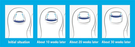 Onyfix Painless Treatment For Ingrown Toenails Footsmart Podiatry