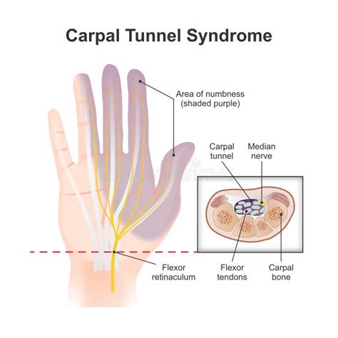 Carpal Tunnel Syndrome Illustration Stock Illustration Illustration