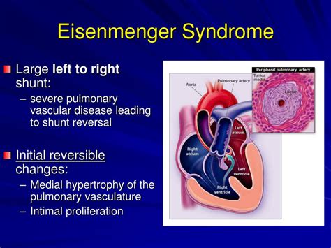 Ppt Congenital Heart Diseases Ii Powerpoint Presentation Free
