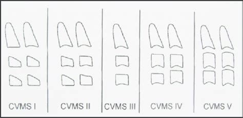 The Newly Improved Cervical Vertebral Maturation Cvm Method 10 Download Scientific Diagram