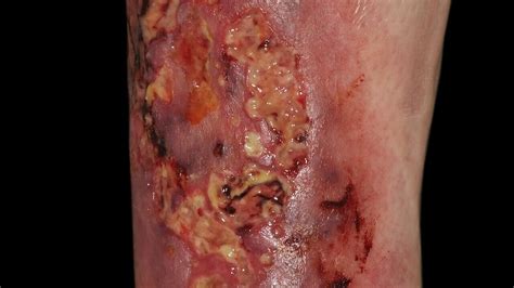 Peristomal Pyoderma Gangrenosum