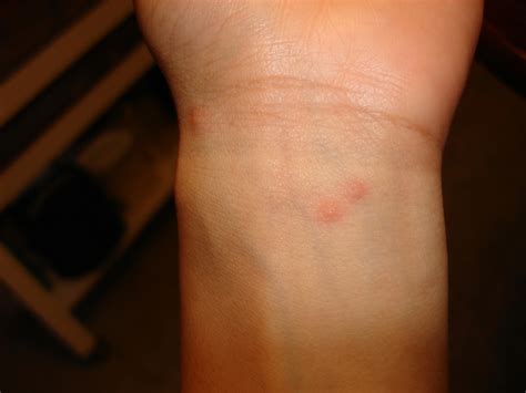 Minor Bed Bug Bites On Back