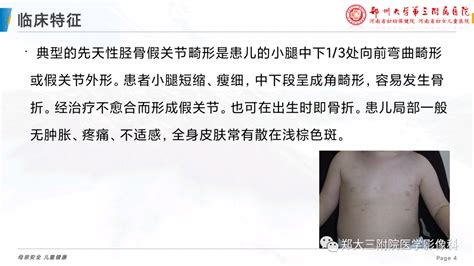 【ppt】儿童先天性胫骨假关节 影像ppt