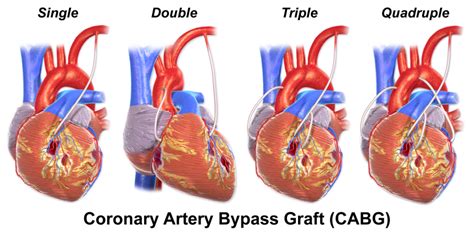 What Is Difference Between Cabg And Pci Compare The Difference