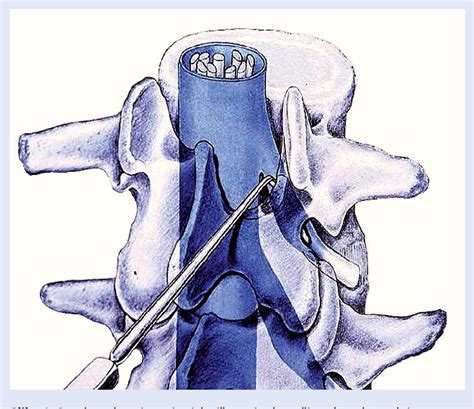 Lumbar Spinal Stenosis And Lateral Recess Syndrome Semantic Scholar