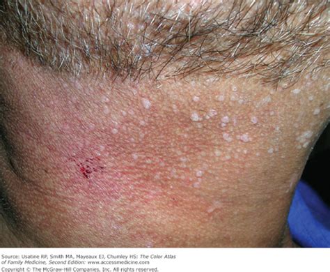 Flat Warts Basicmedical Key