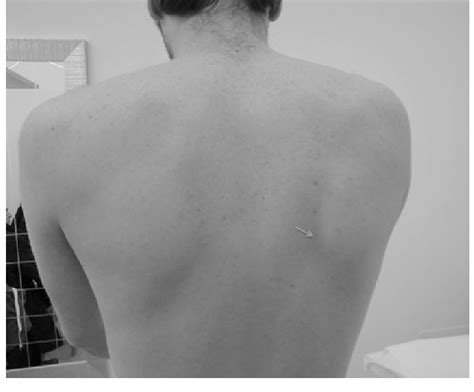 Type I Scapular Dyskinesis Download Scientific Diagram