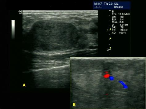 A Ultrasonography Shows Solid Masses In The Left Breast With A Sharp Download Scientific