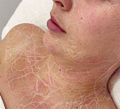 Dmk Enzyme Therapy Natural Skinn Skin Clinic Birmingham