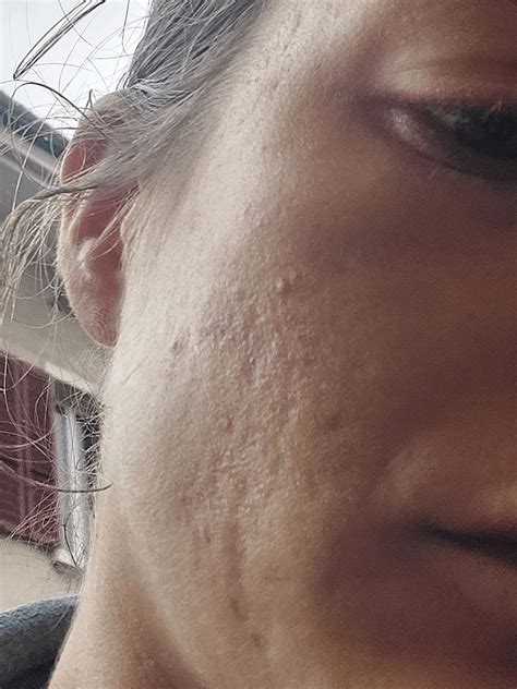 About 15 Months Post Subcision Radiesse 11 Diluted Did It Get