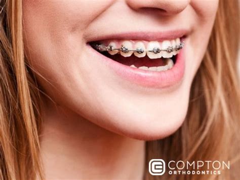 Do You Have A Malocclusion Braces Can Help Artofit
