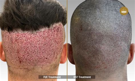 Hst Vs Fue Advantages And Benefits Hair Science Indonesia