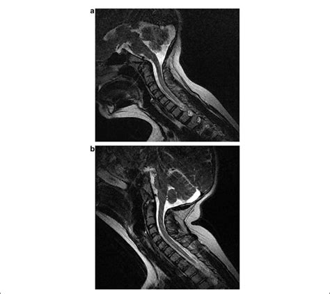 A The Craniocervical Junction In Flexion Showing A Forward Slide Of