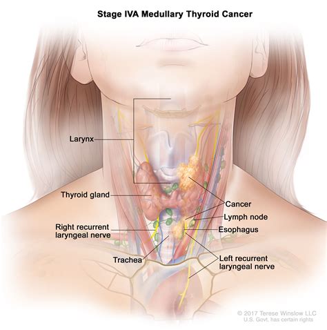 About Thyroid Cancer University Hospitals
