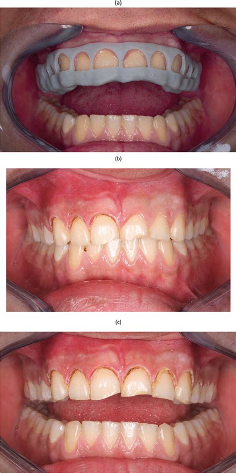 Electrosurgical Gingivectomy At Shirley Bock Blog