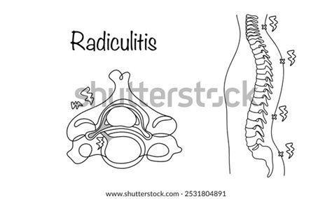 45 Imágenes Fotos De Stock Objetos En 3d Y Vectores Sobre Radiculitis