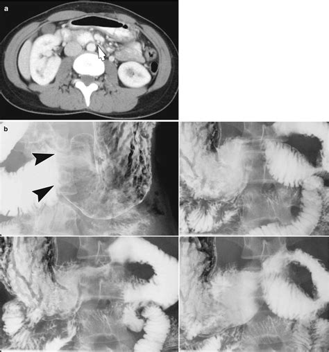 Benign Structural And Functional Abnormality Of The Stomach And Duodenum Radiology Key