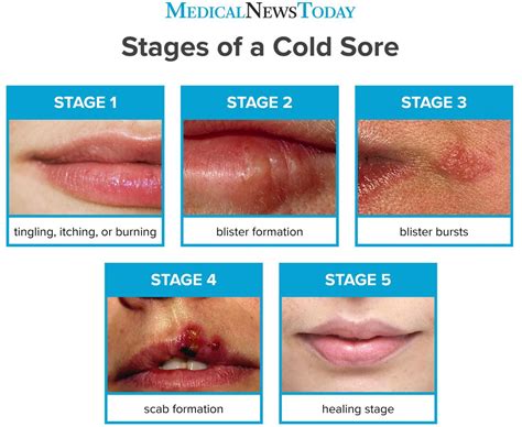Why Am I Getting Cold Sores Suddenly At Harry Quintana Blog