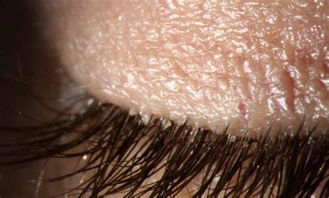 Understanding Demodex Mites And Blepharitis Fort Lauderdale Eye Institute