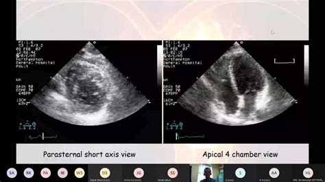 21 06 04 Echocardiogram Interpretation Youtube